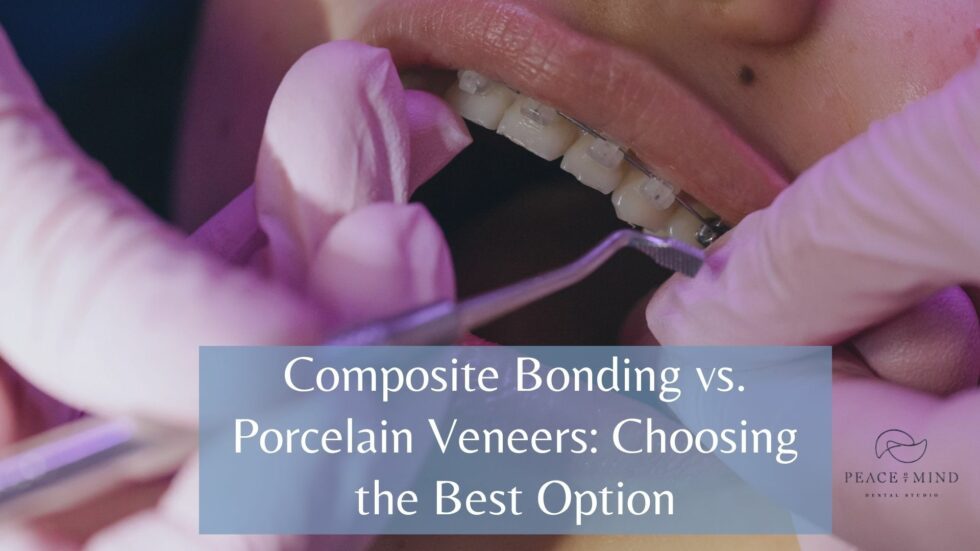 Composite Bonding vs. Porcelain Veneers: Choosing the Best Option