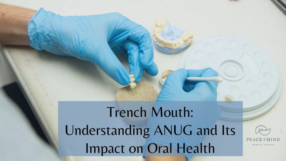 Trench Mouth: Understanding ANUG and Its Impact on Oral Health