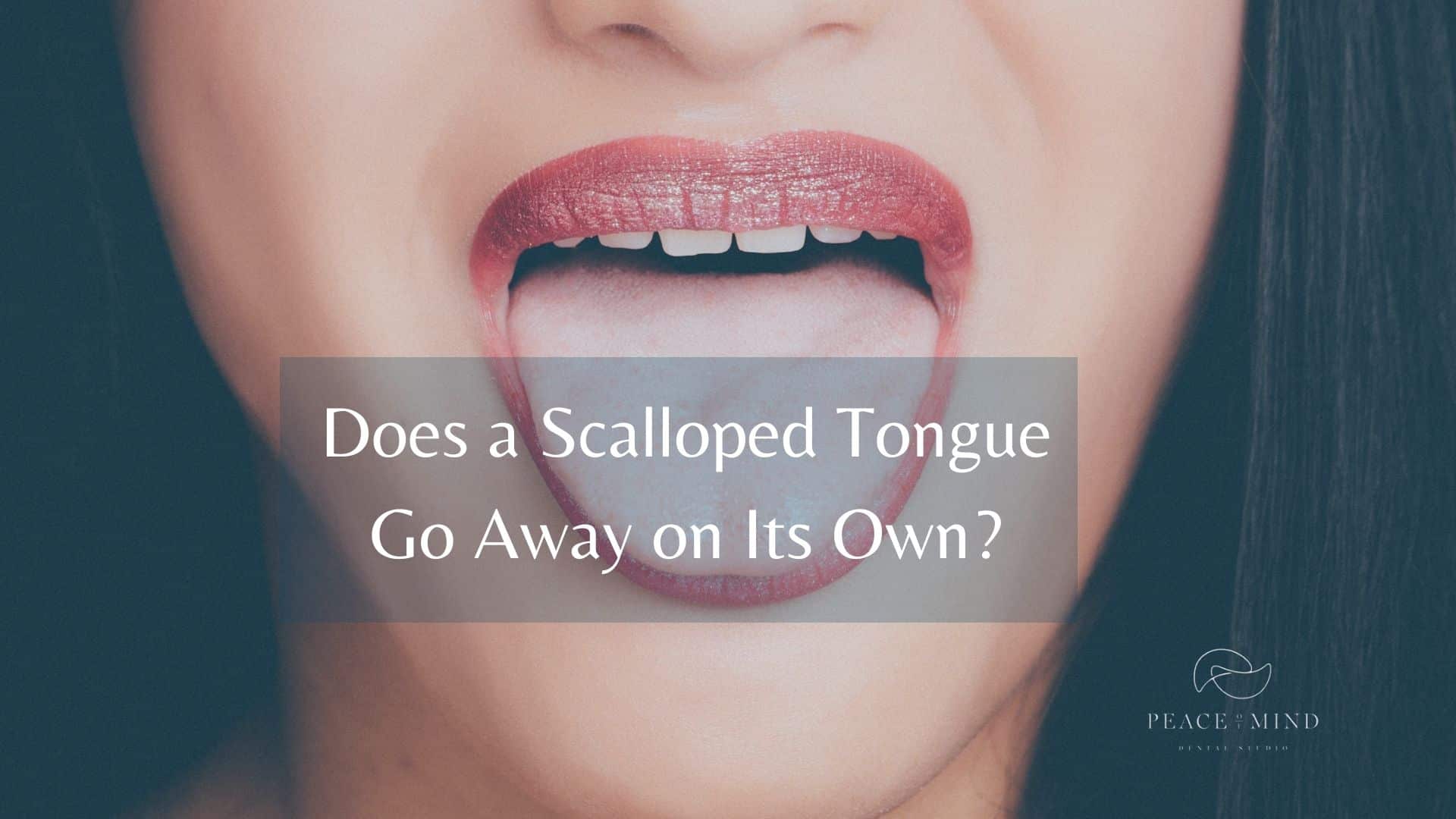 Does a Scalloped Tongue Go Away on Its Own?