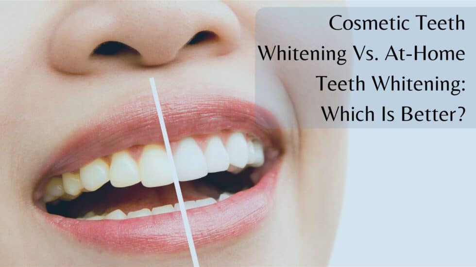 Cosmetic Teeth Whitening Vs. At-Home Teeth Whitening: Which Is Better?