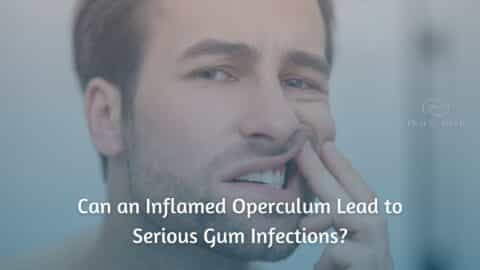 Can an Inflamed Operculum Lead to Serious Gum Infections?