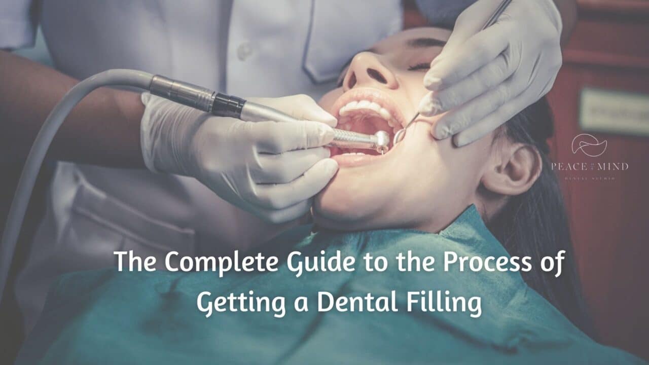 The Complete Guide to the Process of Getting a Dental Filling